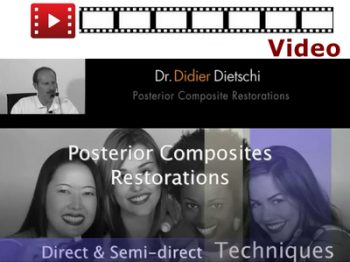 Posterior Composites Restorations: Direct & Semi-Direct Techniques