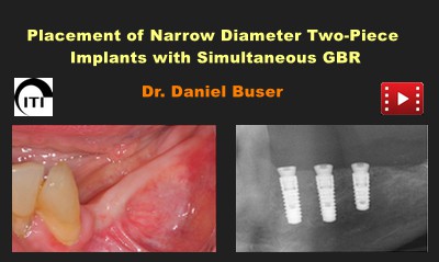 Placement of Narrow Diameter Two-Piece Implants with Simultaneous GBR