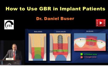 How to Use GBR in Implant Patients