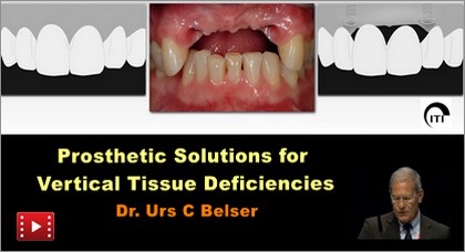 Prosthetic Solutions for Vertical Tissue Deficiencies